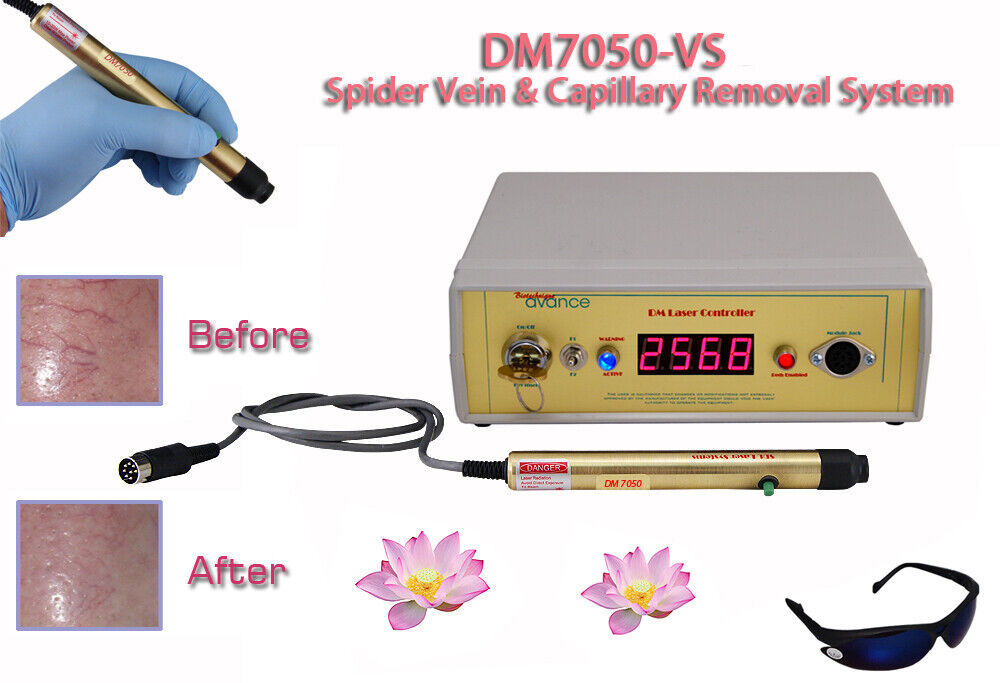 Laser Brand New treatment of capillary and spider veins. Permanent ...
